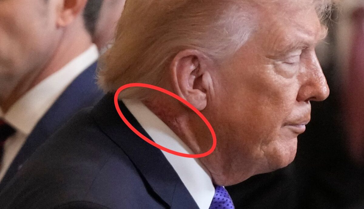 Trump Critics Go Wild Over Photo of Rash on His Neck